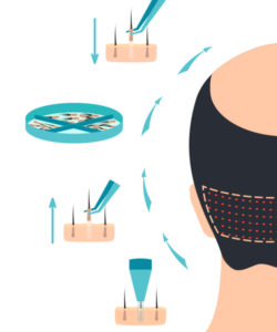 OxyCure and the donor region – OxyCure Therapy